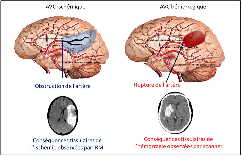 Quelles sont les causes de l AVC ? | Institut du Cerveau