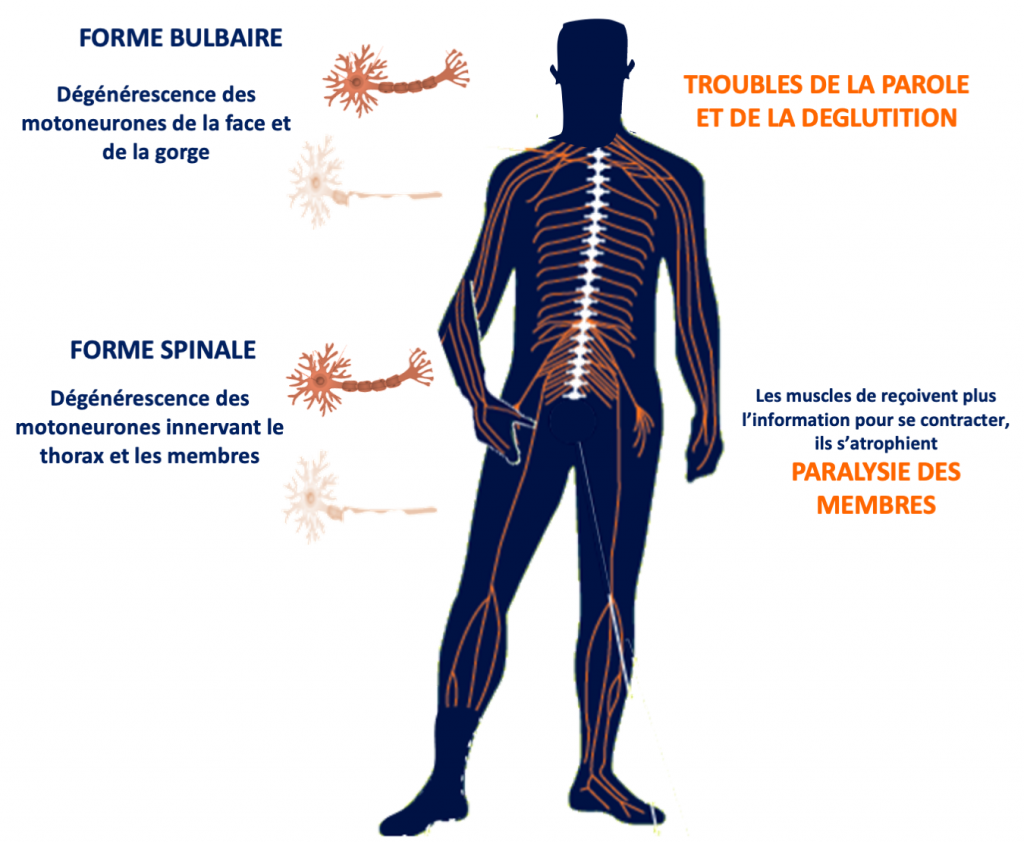 Les signes et symptômes de la maladie de Charcot (SLA)