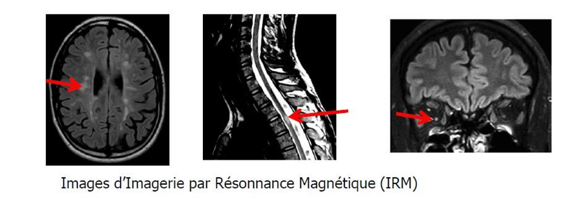 Les mécanismes biologiques de la Sclérose en Plaques (SEP)
