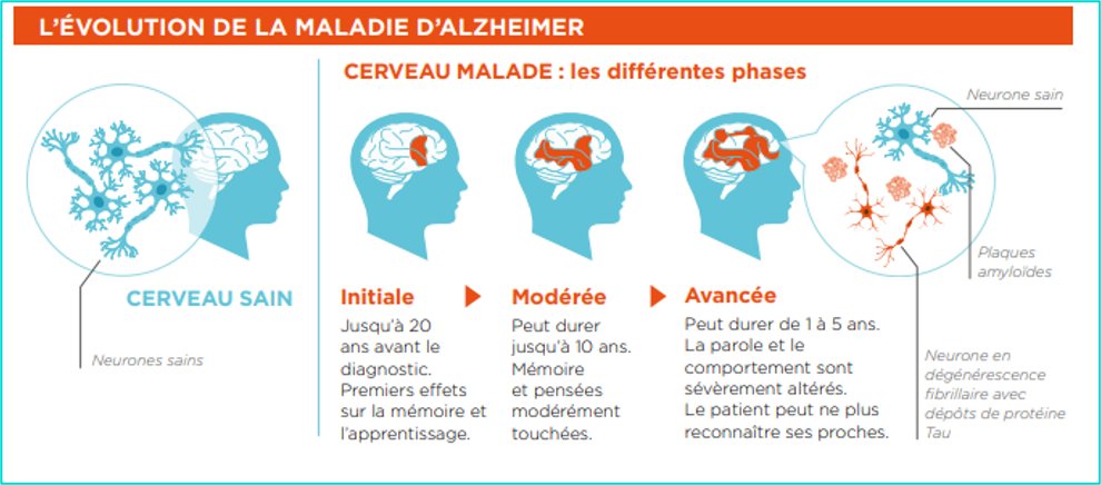 Quel est le diagnostic de la maladie d'Alzheimer