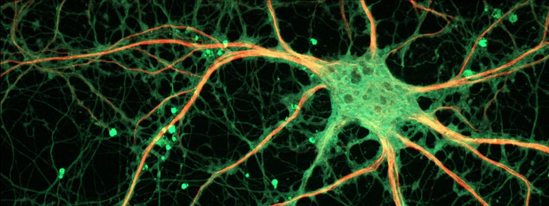 Paraplégie Spastique héréditaire ou maladie de Strumpell Lorrain