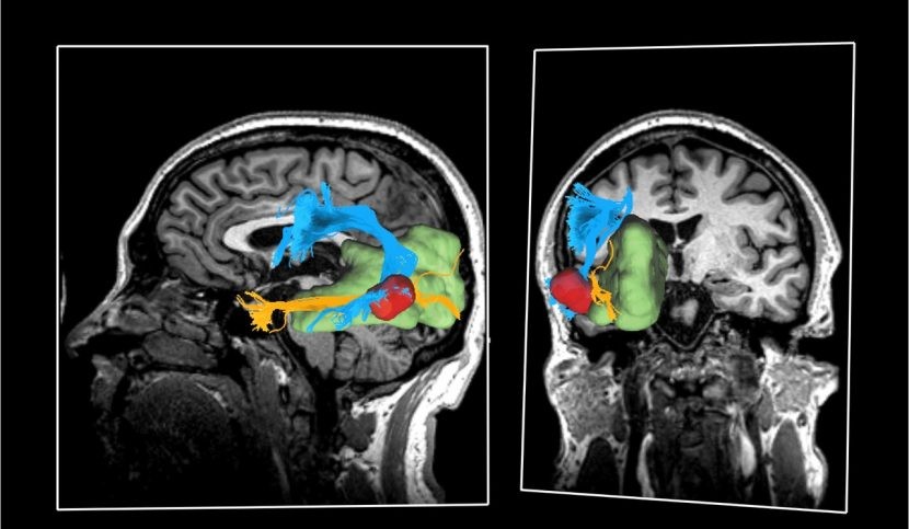 Comprendre en 2 minutes : l'Accident Vasculaire Cérébral (AVC ...