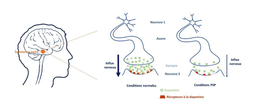 Quels sont les mécanismes biologiques de la PSP