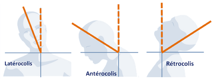 Quels sont les symptômes de la Dystonie ? | Institut du Cerveau