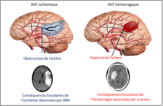Quelles sont les causes de l AVC ? | Institut du Cerveau